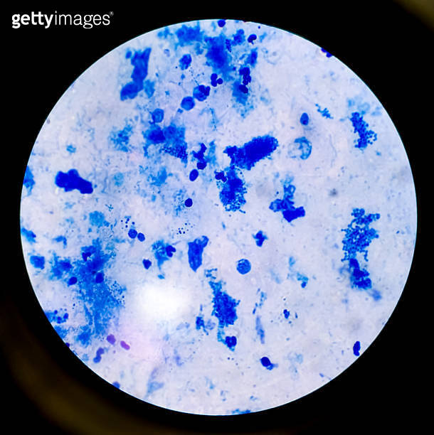 Sputum smear AFB, Acid Fast Bacillus stain microscopic show no gram ...