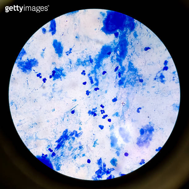 Sputum smear AFB, Acid Fast Bacillus stain microscopic show no gram ...