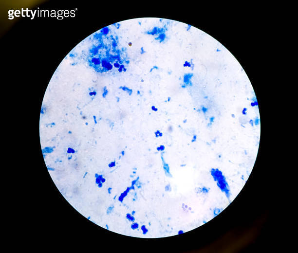 Sputum smear AFB, Acid Fast Bacillus stain microscopic show no gram ...