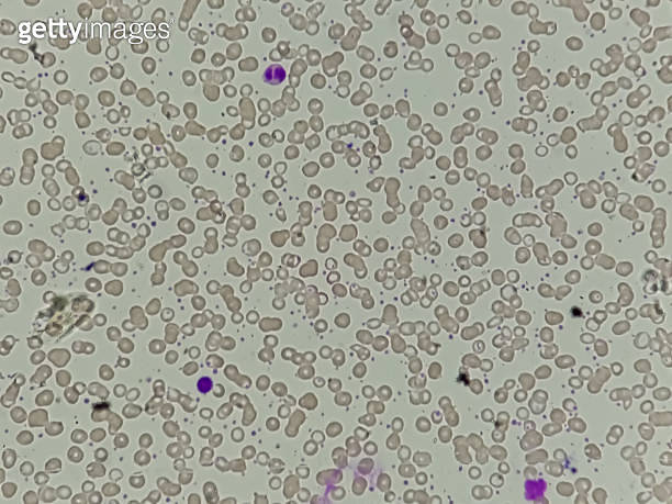 Hematology blood smear leishman stain under light microscope show ...
