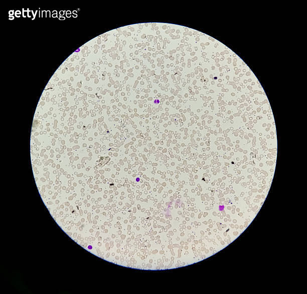 Hematology blood smear leishman stain under light microscope show ...