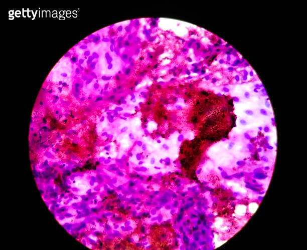 FNAC of lymph nodes tissue Cytology microscopic 100x show ...