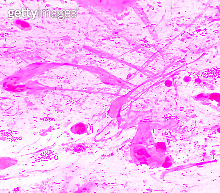 Wound swab or pus Gram stain microscopic 100x objective show Gram ...