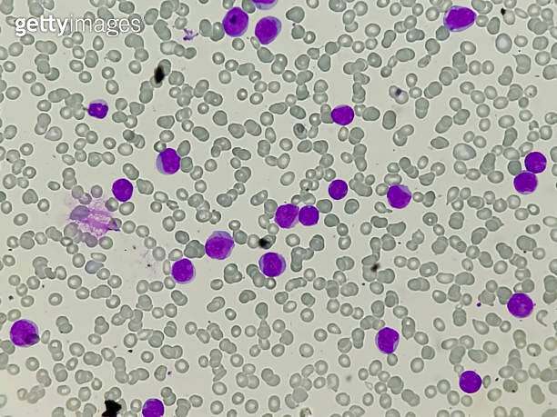 Blood smear Microscopic image of Chronic Mylohyoid Leukemia (CML ...