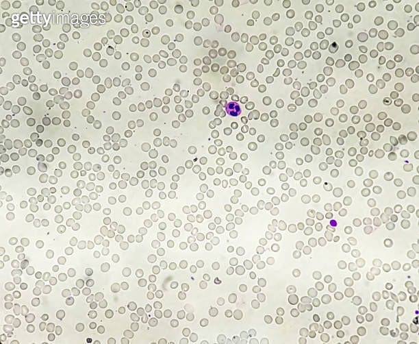 Blood smear leishman stained Microscopic 100x show leucocytopenia and ...