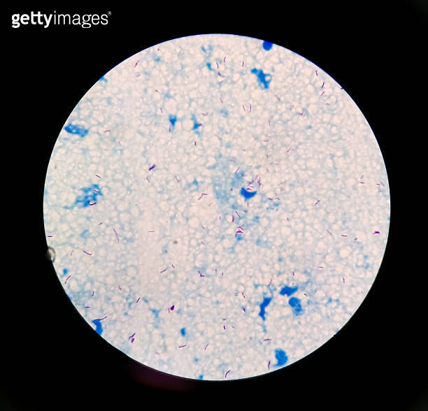 Microbacterium Tuberculosis Bacteria (MTB) 이미지 (1342438821) - 게티이미지뱅크