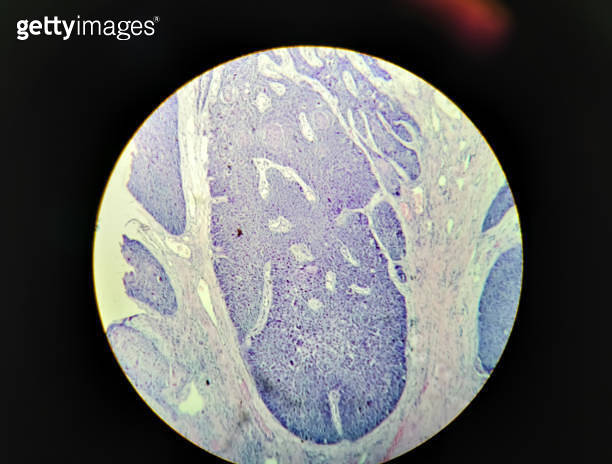 Lobular Capillary hemangioma, light micrograph, photo under microscope ...
