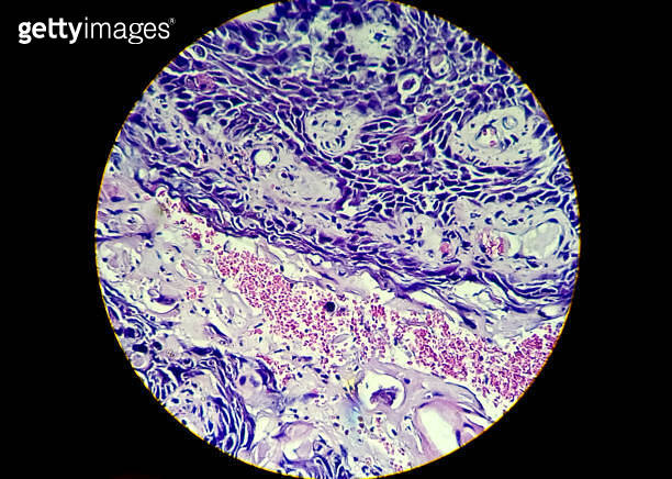 Lobular Capillary hemangioma, light micrograph, photo under microscope ...