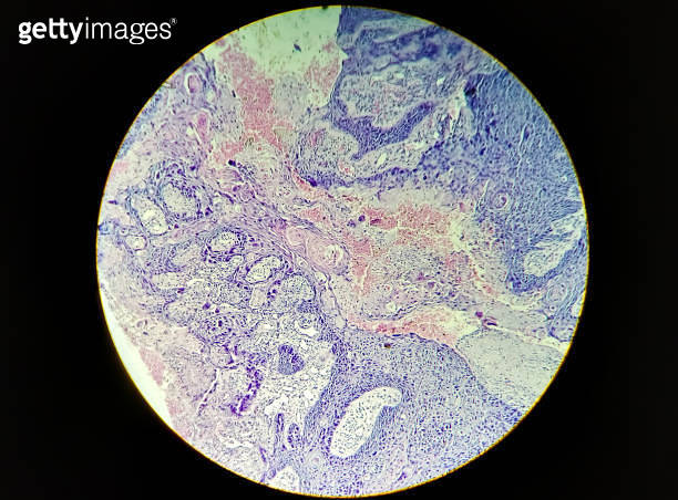 Capillary hemangioma, light micrograph, photo under 200x microscope ...