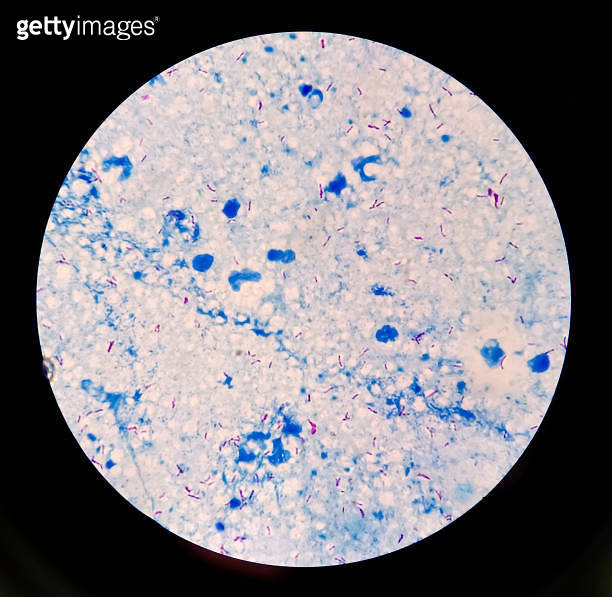 Sputum smear AFB stain microscopic 100x show plenty of Macrobacterium ...
