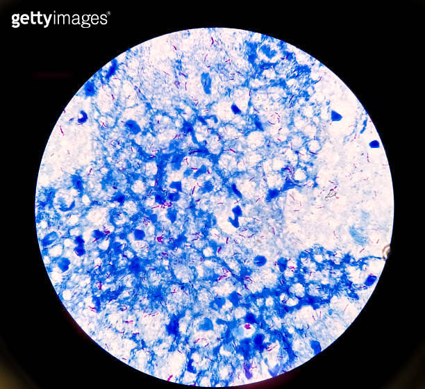 Sputum smear AFB stain microscopic 100x show plenty of Macrobacterium ...