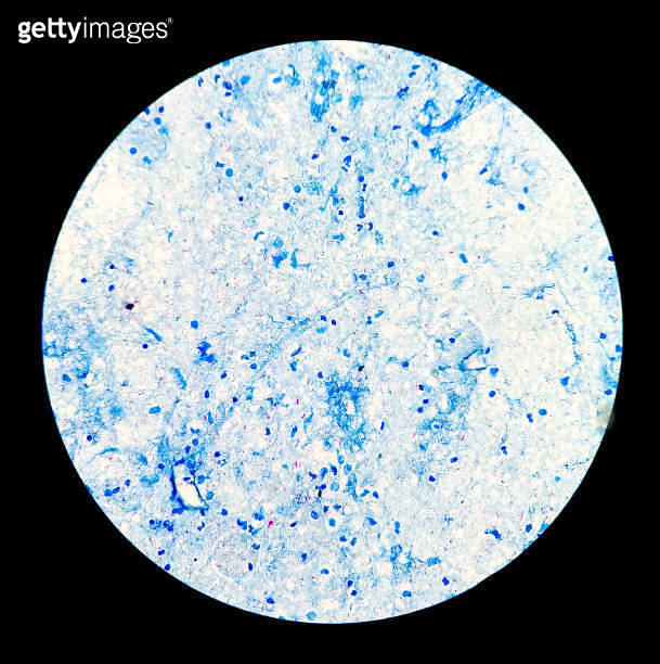 Sputum smear AFB stain microscopic 100x show plenty of Macrobacterium ...