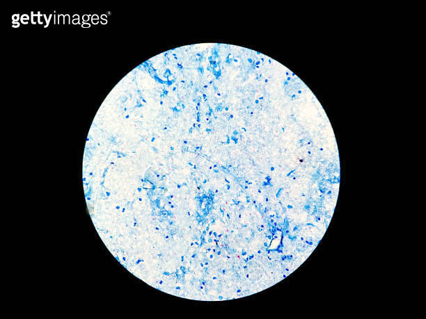 Sputum AFB stain microscopic show Microbacterium Tuberculosis (TB ...