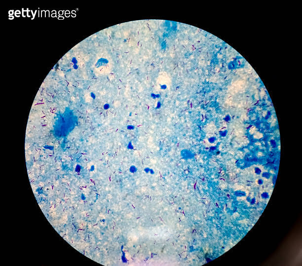 Sputum smear AFB stain microscopic 100x show plenty of Macrobacterium ...