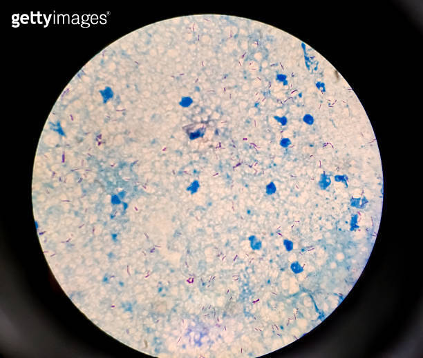 Sputum AFB stain microscopic show Microbacterium Tuberculosis (TB ...