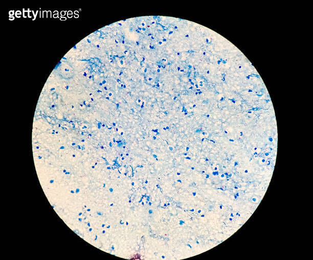 Sputum AFB stain microscopic show Microbacterium Tuberculosis (TB). 이미지 ...