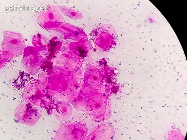 Prostatic Smear (P/S) gram stain microscopic 100x show few pus cells ...