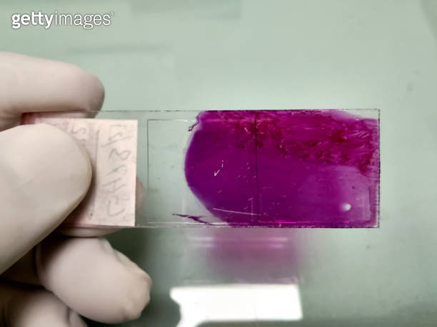 FNAC, Fine Needle Aspiration Cytology test microscopic Pap stained ...