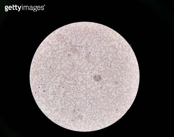 Hematological, CBC blood film microscopic show leucocytopenia. No white ...