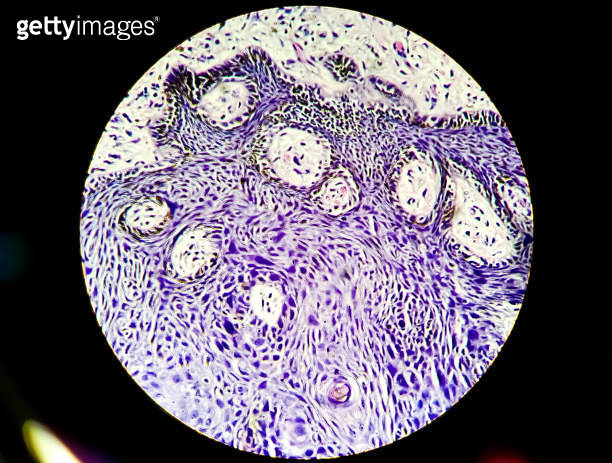 Lobular Capillary hemangioma, light micrograph, photo under microscope ...