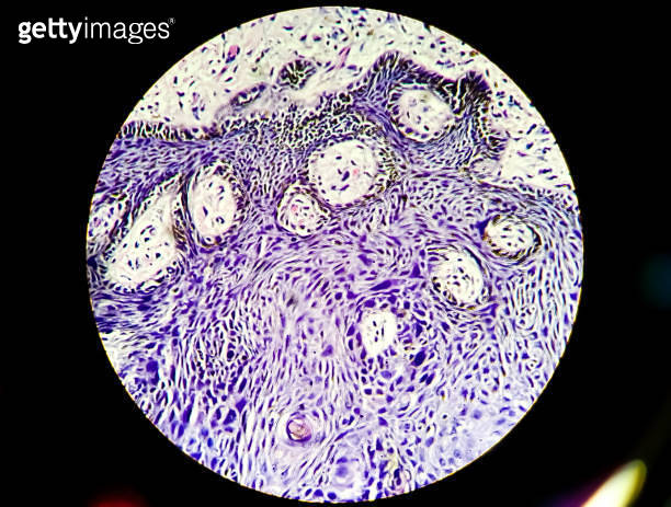 Lobular Capillary hemangioma, light micrograph, photo under microscope ...