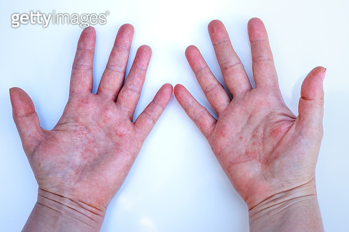 Atopic Dermatitis, Red hands, Dermatological problem, Female hands ...