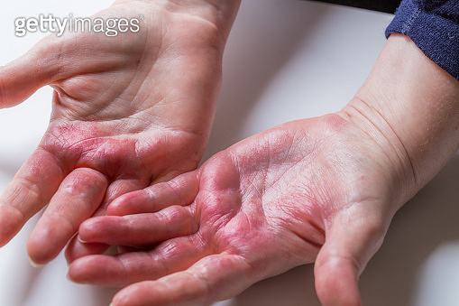 Atopic dermatitis, Red, itchy hands with blisters and chapped skin ...