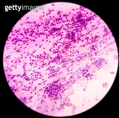 High grade squamous intraepithelial lesion(HSIL). Photomicrograph of ...