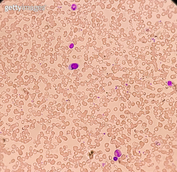 Hereditary hemolytic anemia. Hemoglobin E (HbE) disease, hypochromia ...