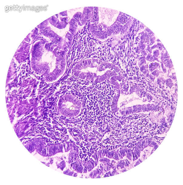 Uterus: Chronic cervicitis with CIN-1, under light microscope show ...