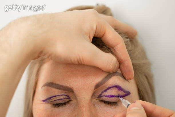 Blepharoplasty markup close-up on the face before the plastic surgery ...
