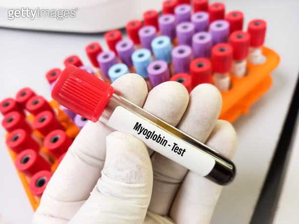 Blood sample for Myoglobin test, diagnosis of acute myocardial ...