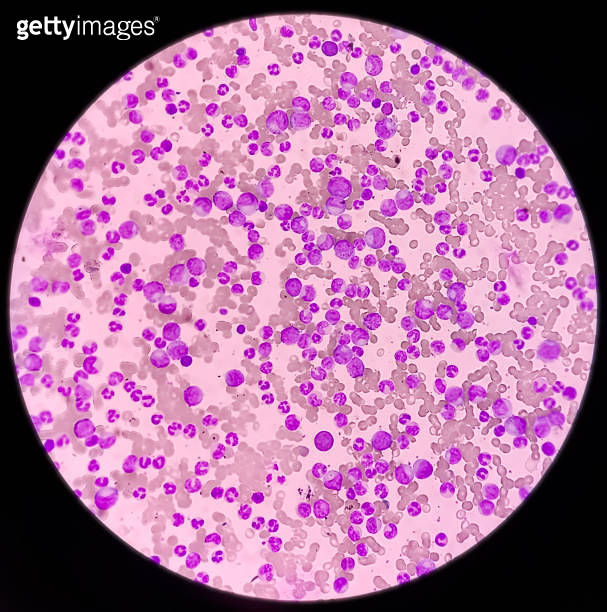 Blood cancer. Chronic myelogenous leukemia, also known as Chronic ...