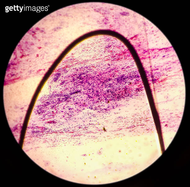 Vault smear: Reactive cellular changes with inflammation, photo under ...