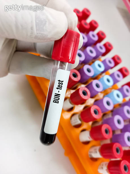 Blood sample for BUN (blood urea nitrogen) test. Diagnosis of kidney or ...