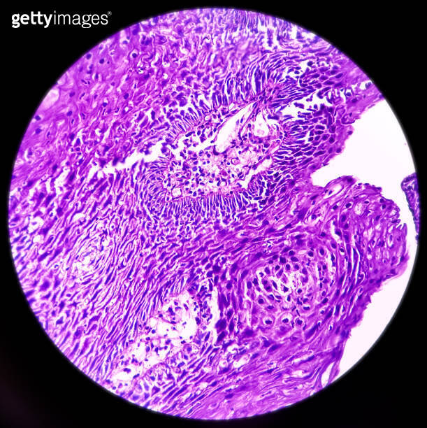 Microscopic image of esophageal cancer, Invasive Squamous cell ...