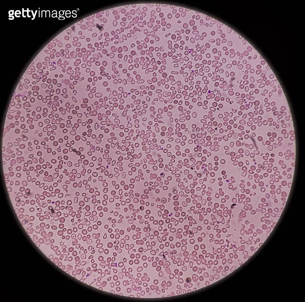 Hereditary hemolytic anemia. Hemoglobin E (HbE) disease, hypochromia ...
