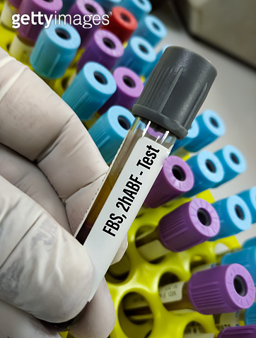 Technician hold a sample tube of FBS and 2hABF test (1342187608) - 게티이미지뱅크