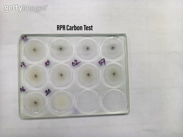 Rpr Vdrl Syphilis Test Glass Slide Agglutination Method Showing Nonreactive Result 이미지
