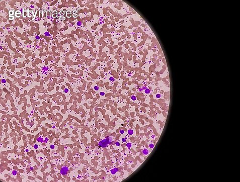 Thrombocythemia, Essential thrombocytosis blood smear, present abnormal ...