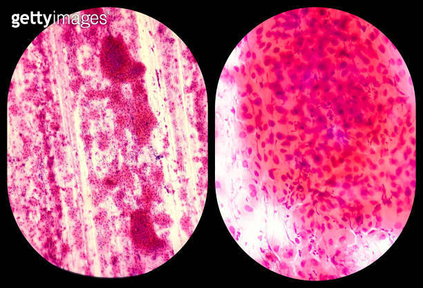 Vault smear: Reactive cellular changes with inflammation, photo under ...