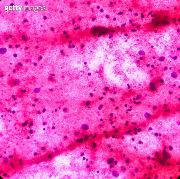 Breast lump malignant cell ductal carcinoma, FNAC slide microscopic ...