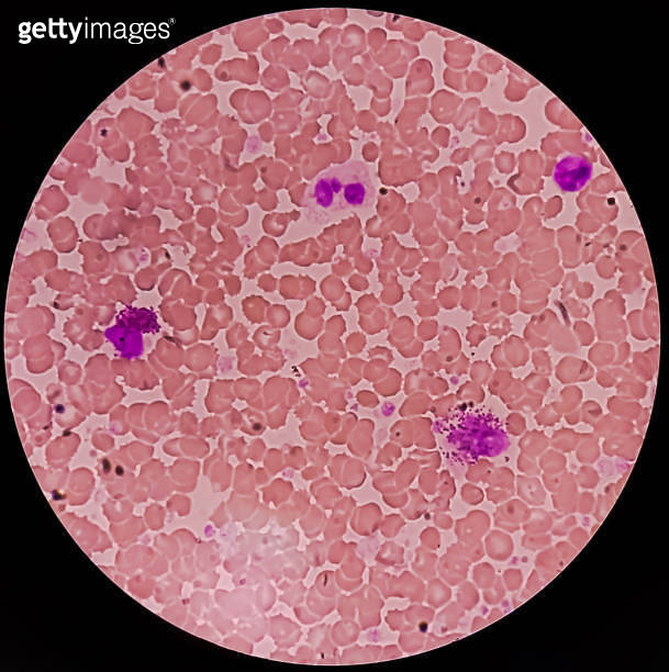 Pancytosis, blood smear showing clumps or high volume of platelet and ...