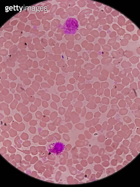 Pancytosis, blood smear showing clumps or high volume of platelet and ...