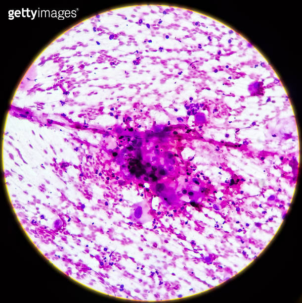 Microscopic view of Metastatic squamous cell carcinoma, atypical ...