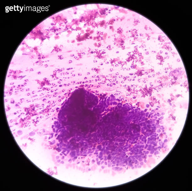 High grade squamous intraepithelial lesion(HSIL). Photomicrograph of ...