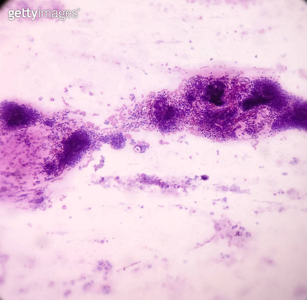 High grade squamous intraepithelial lesion(HSIL). Photomicrograph of ...