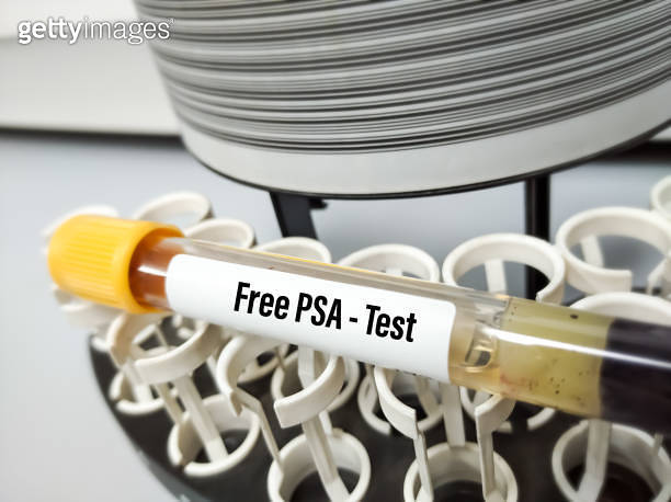 Blood sample for free PSA test. Diagnosis of prostate cancer ...
