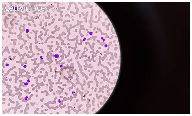 Leuco-erythroblastic anaemia and Chronic myelomonocytic leukemia (CMML ...