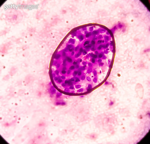 Vault smear: Reactive cellular changes with inflammation, photo under ...